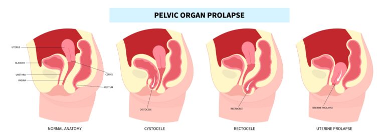 What is a vaginal prolapse and can it be fixed?